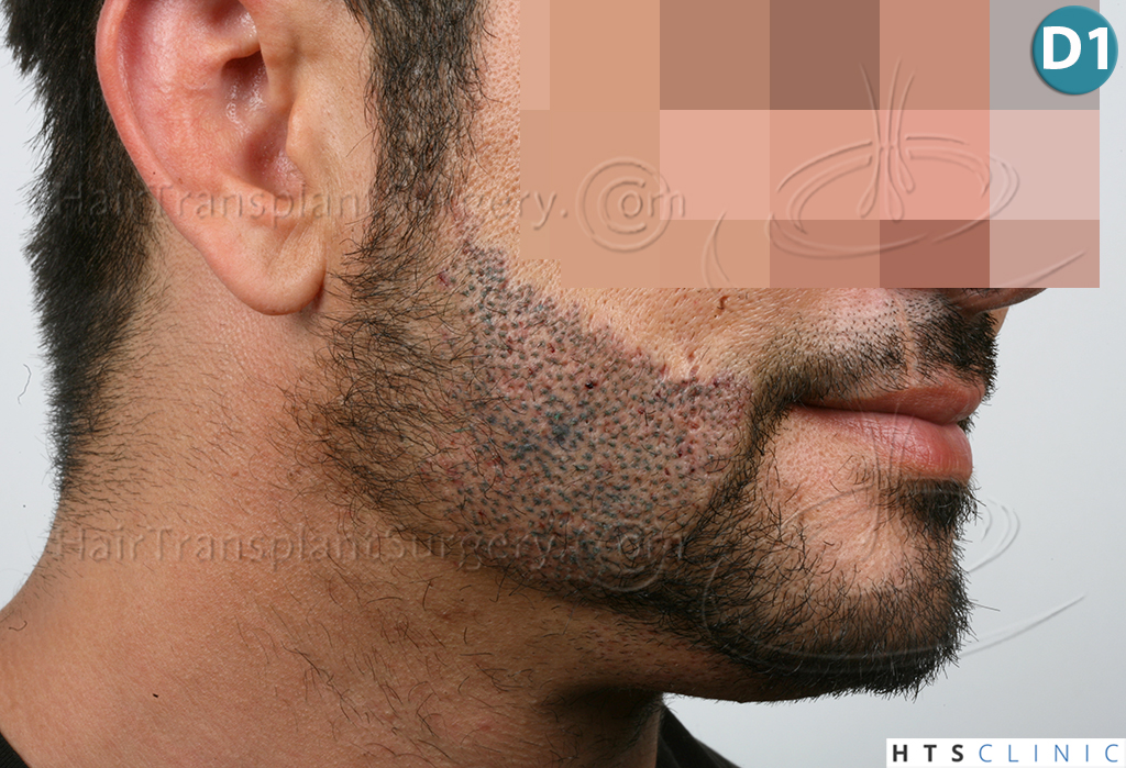 Dr Jean Devroye Hts Clinic 1124 Fue Beard Reconstruction